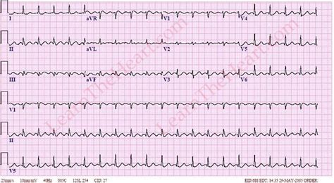 atrial flutter with 2 1 conduction example 1