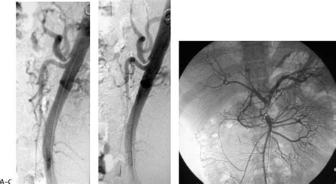20 Median Arcuate Ligament Syndrome Radiology Key