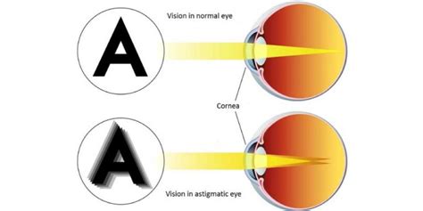 Astigmatism Types Symptoms Causes Risks Diagnosis And Treatment