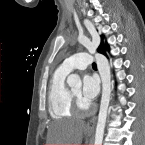 Interrupted Aortic Arch Type A Image