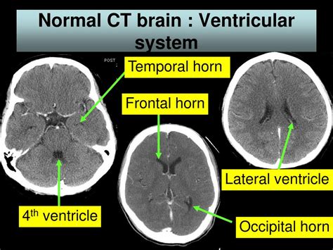 Ppt Imaging Of The Cns Powerpoint Presentation Free Download Id