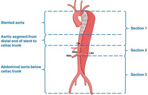 Frontiers Long Term Aortic Remodeling After Thoracic Endovascular