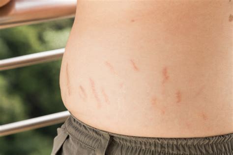 Stretch Marks On Men The Complete Guide Manscaped Com