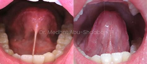 Tongue Tie Mypediaclinic Pediatric Tongue Tie Surgery In Dubai