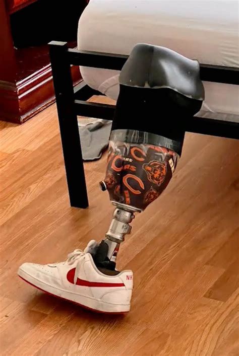 Missouri Man Says American Airlines Lost His Prosthetic Leg Wont Pay