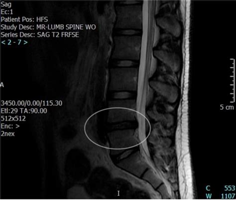Herniated Disc Mri L5 S1 Lumbar Herniated Disc A More In Depth Look