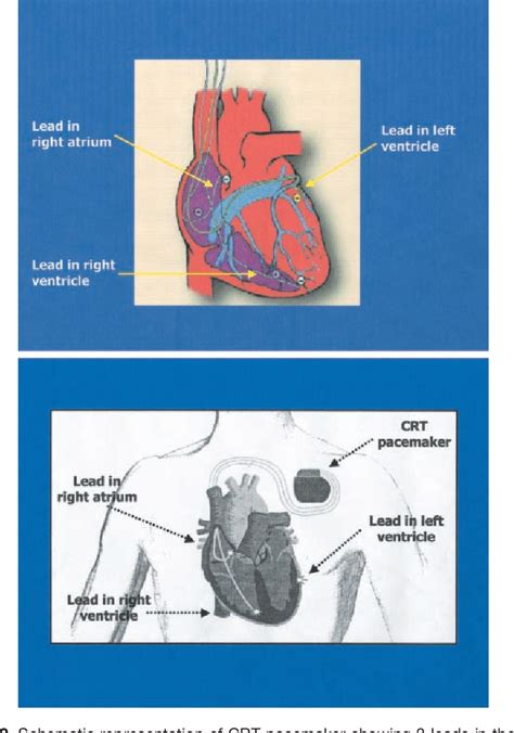 Figure 2 From Cardiac Resynchronization Therapy A Patients Guide
