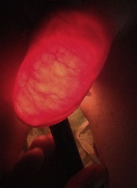Abdominoscrotal Hydrocele Role Of Physical Exam And Transillumination