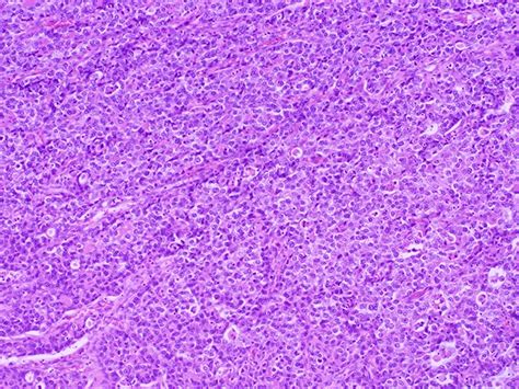 Pathology Outlines Clear Cell Carcinoma