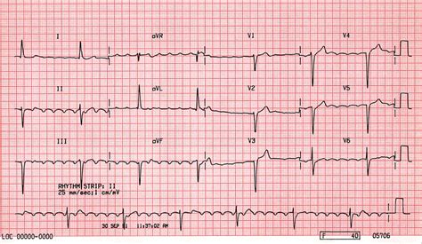 case b10 complete heart block and atrial flutter st emlyn s ecg