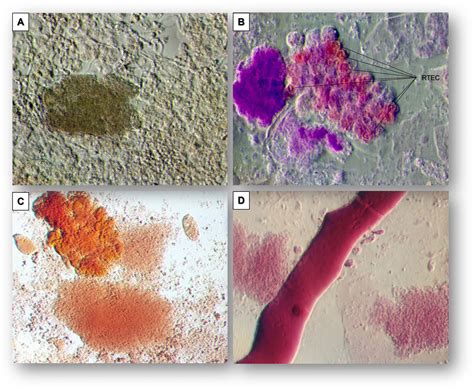 Urine Sediment Of The Month Urinal Sediment Microscopy