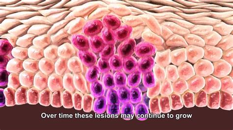 Actinic Keratosis Youtube