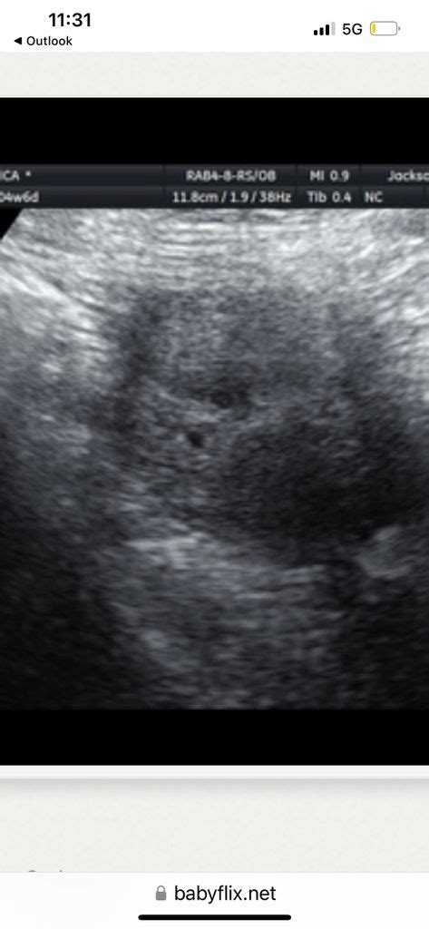 Omg Possible Missed Twin Multiples And Twins Forums What To Expect