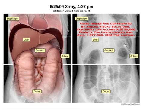 Amicus Illustration Of Amicus Radiology Abdomen Abdominal Cavity X Ray