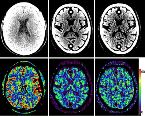 Quantitative Dose Dependency Analysis Of Whole Brain Ct Perfusion
