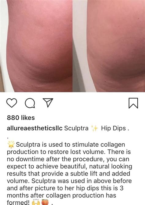 Pin By Jen Burrink On Fitness Body Surgery Plastic Surgery Hips Dips