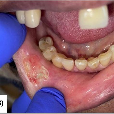 Pdf Cytomegalovirus‐induced Oral Ulcers A Case Report And Literature