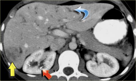 The Radiology Assistant Biliary Ducts Pathology