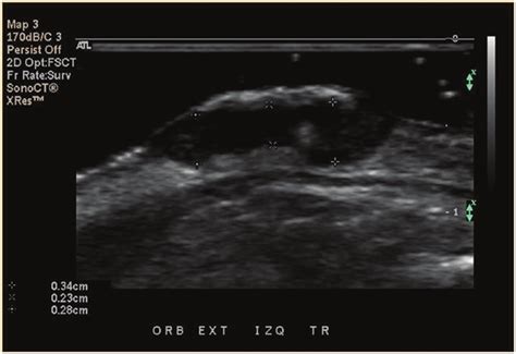 Bcc Tumor Ultrasound Shows An Oval And Hypoechoic Lesion Three