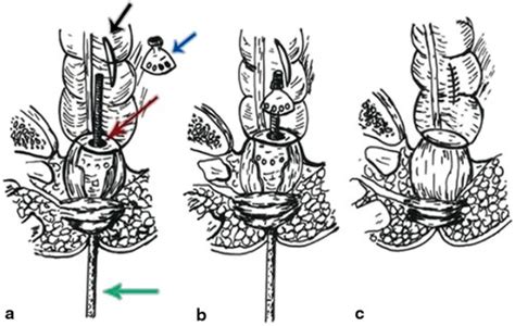 Congenital Rectal Stenosis And Atresia Springerlink