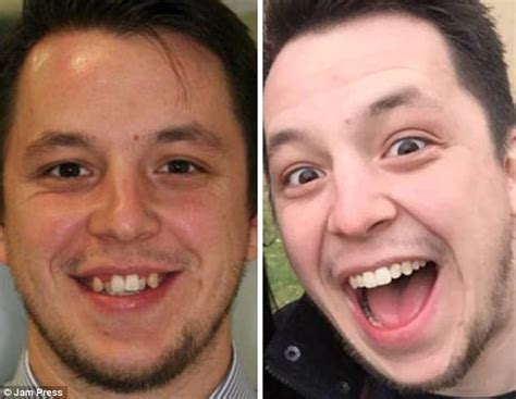 Brace Wearers Share Their Before And After Pictures Daily Mail Online