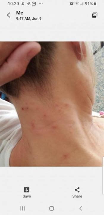 A Photo Of A Neck Rash Submitted By One Of Our Readers Itchy Rash