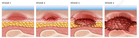 Stages Of Skin Ulcers