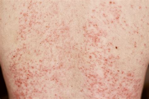 Contact Dermatitis Cathedral Dermatology