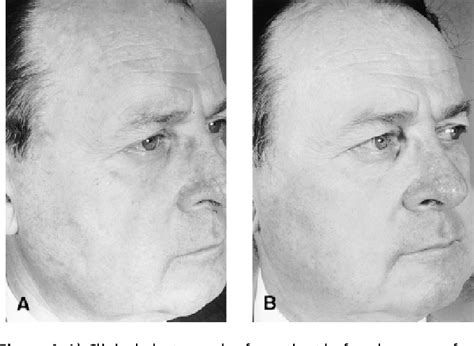 Figure 1 From Er Yag Laser For The Treatment Of Actinic Keratoses