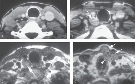 Thyroid Nodules And Malignant Tumors Radiology Key