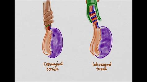 Testicular Torsion Youtube