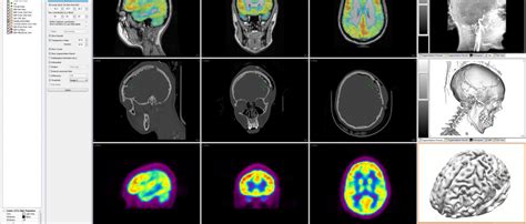 curry neuro imaging suite for epilepsy evaluation compumedics neuroscan
