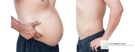 Laparoscopic Sleeve Gastrectomy G And L Surgical Clinic
