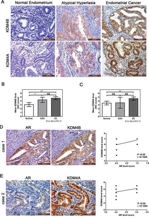 Kdm4b And Kdm4a Promote Endometrial Cancer Progression By Regulating