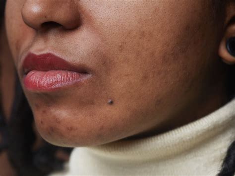 Birth Control For Acne Brands To Try How It Works And More