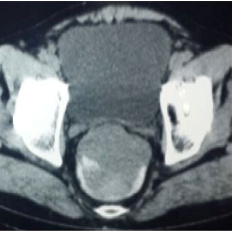 Preoperative Ct Scan Of Rectal Gist Download Scientific Diagram
