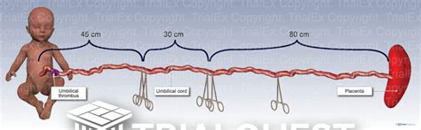 Length Of Umbilical Cord Trialexhibits Inc