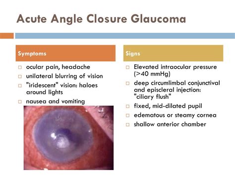 Acute Angle Closure Glaucoma Causes Symptoms Treatment