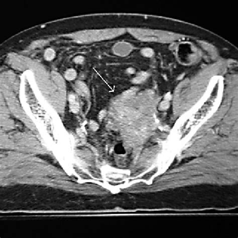 Computed Tomography Of The Abdomen Demonstrates A Pelvic Mass With