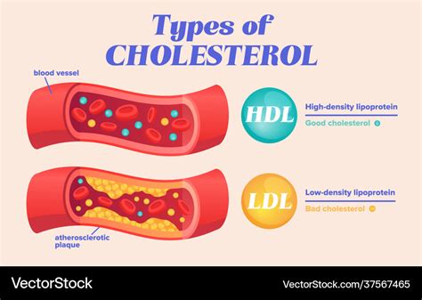 Types Cholesterol Comparison With Hdl And Ldl Vector Image