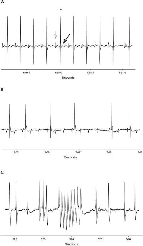 A A Normal Ecg Recording In A Mouse Note That Every P Wave Solid