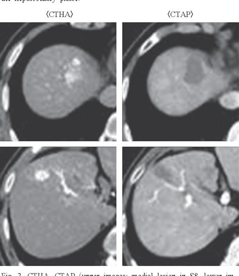 [pdf] A Case Of The Double Cancer Which Was Difficult To Distinguish