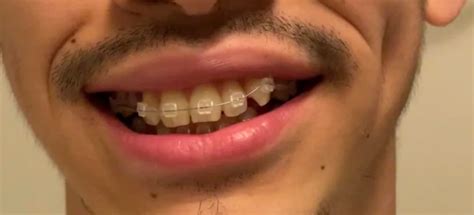 How Can Mewing Fix Underbite Ach