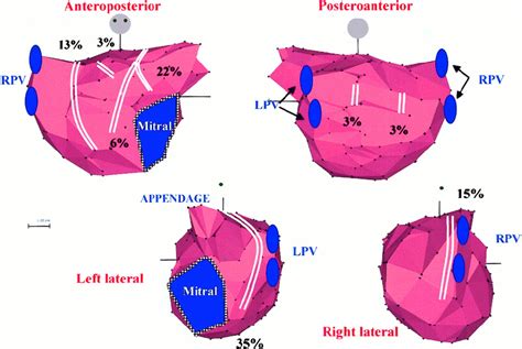 mapping and ablation of left atrial flutters circulation