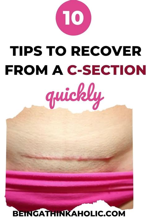 12 C Section Recovery Tips To Heal Fast – Artofit