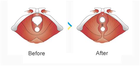 hymenoplasty top hymenoplasty surgery delhi jaipur medispa india