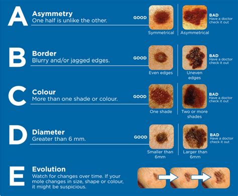 The Abcdes Of Early Detection – Cscf
