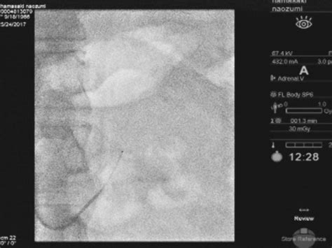 A Novel Method Super Selective Adrenal Venous Sampling Protocol