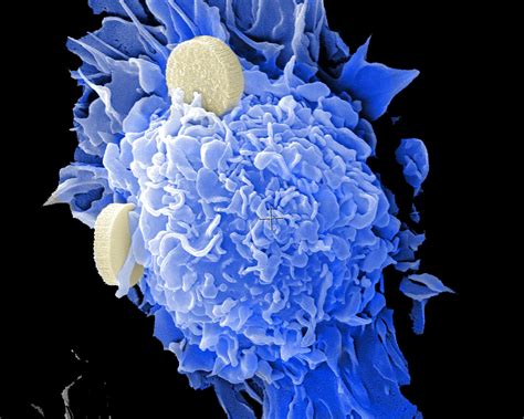 Sex Specific Panel Of 10 Proteins Can Detect 18 Different Early Stage