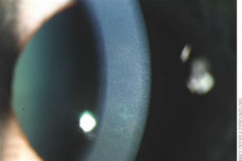 Cataract Surgery In Patients With Fuchs Endothelial Corneal Dystrophy